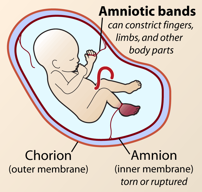 Amniotic Band Syndrome UCSF Fetal Treatment Center Amniotic Band Syndrome UCSF Fetal Treatment Center