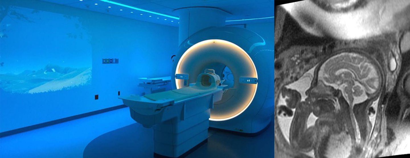 Fetal MRI