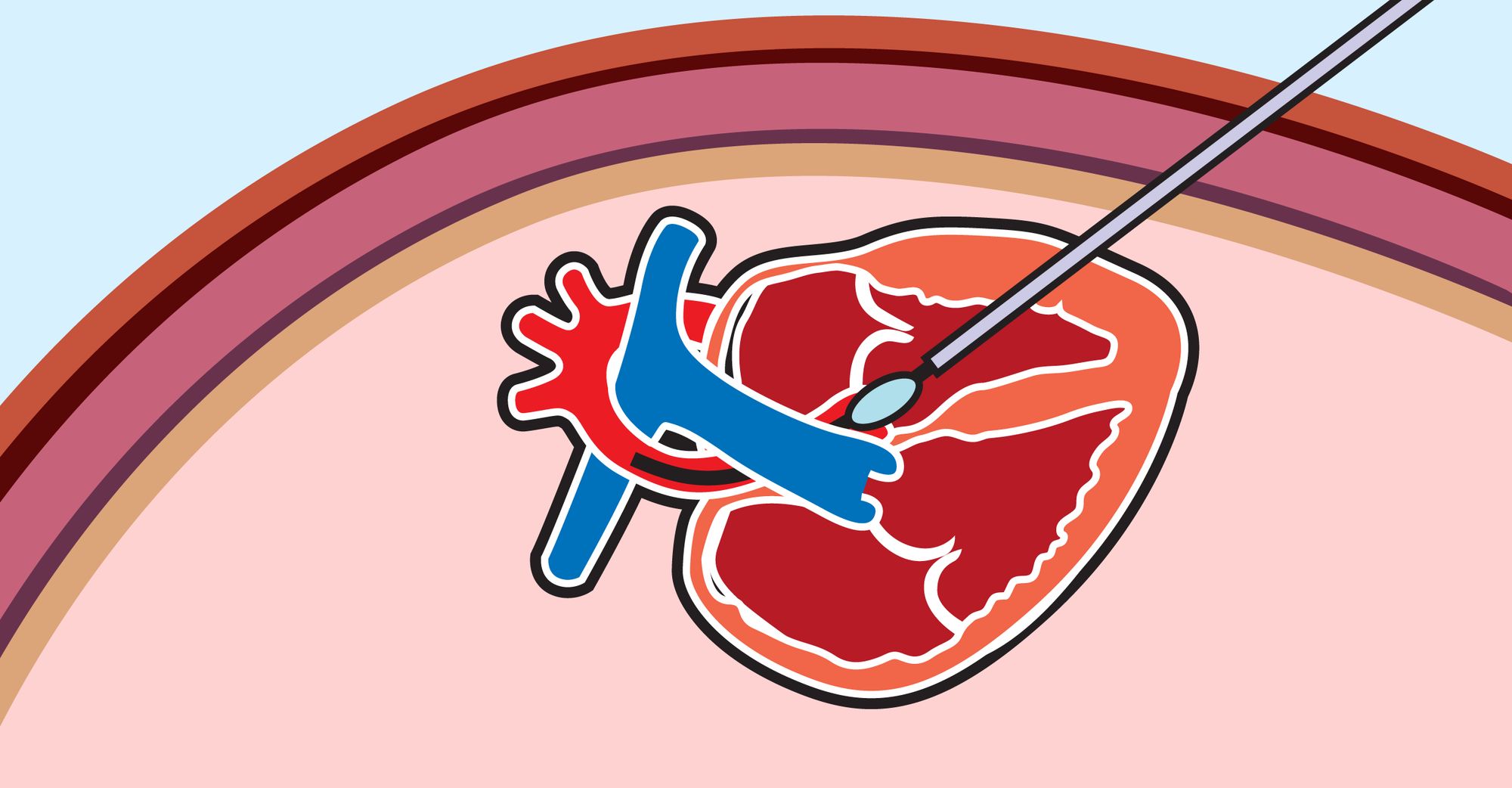 Clinical Trial on Fetal Aortic Valvuloplasty